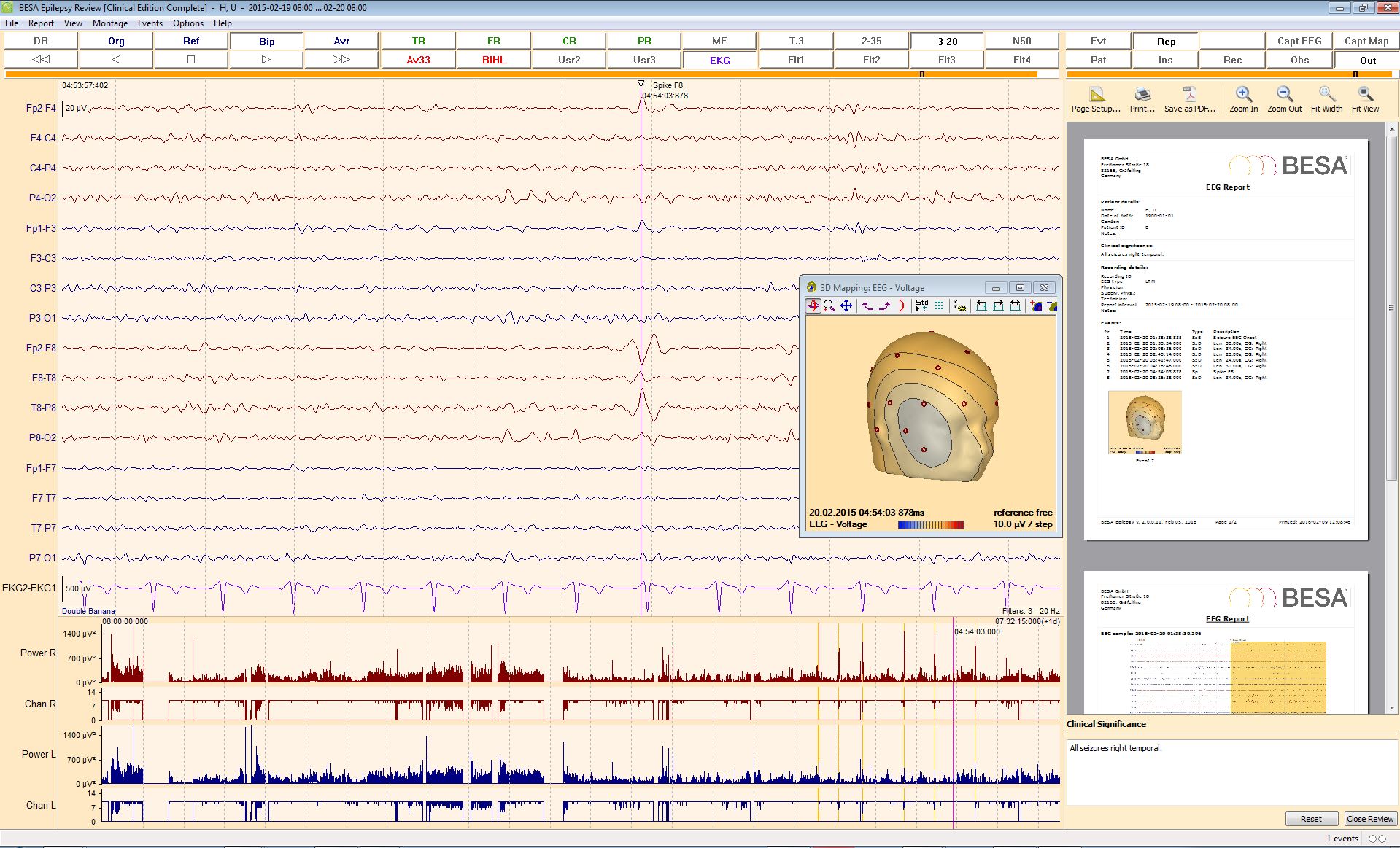 BESA Epilepsy Software | Symbiotic Devices